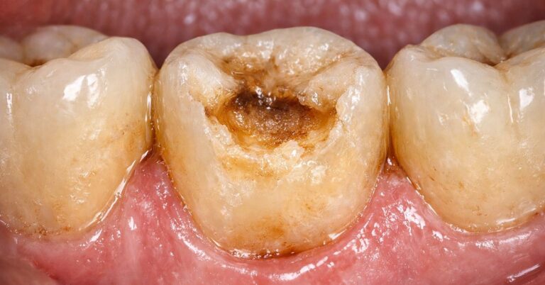 What Is Enamel Erosion? Effects on Teeth | Dr. Ananthi